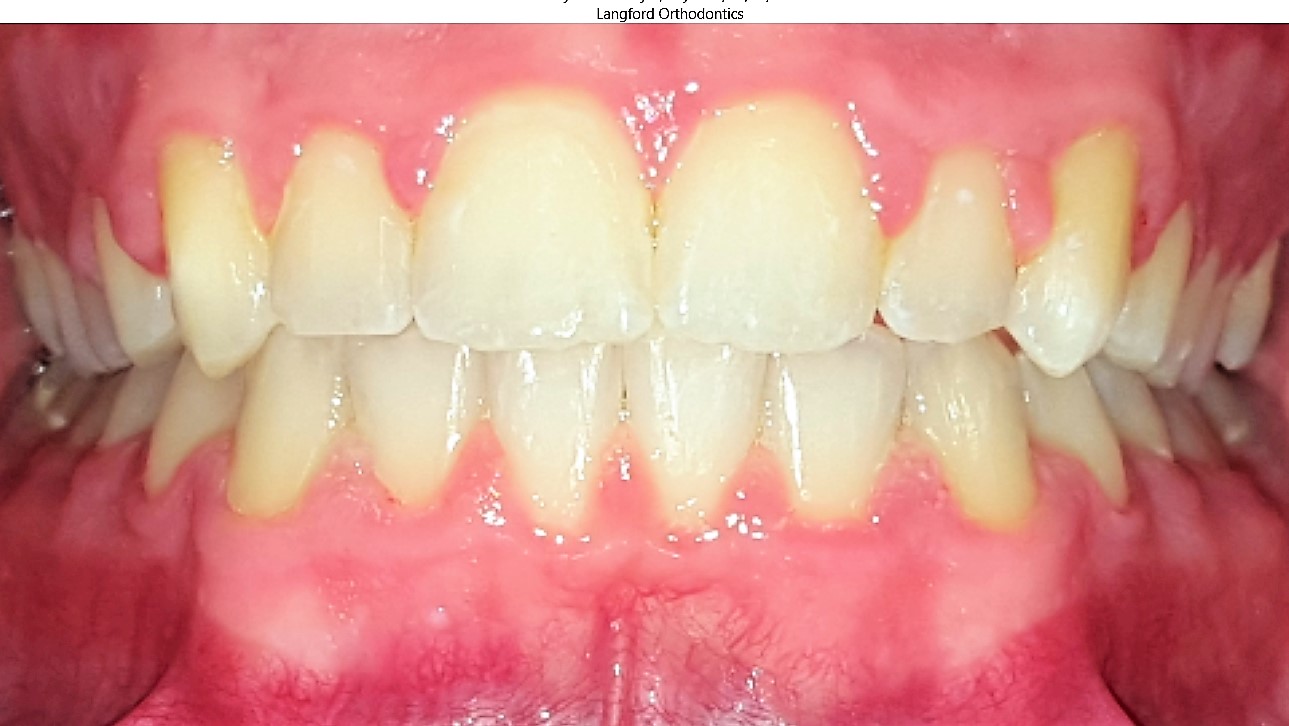 Orthodontics Before & Afters in Knoxville & Seymour, TN